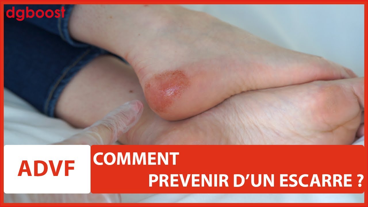 Comment prévenir une escarre ? - Academie Avec